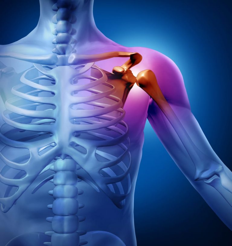 SLAP Lesions of the Shoulder | Causes and Treatments